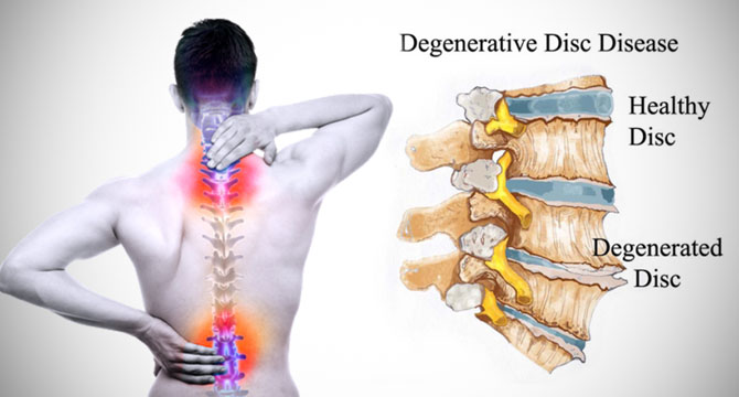 Degenerative disc disease: Can injections help relieve back pain ...